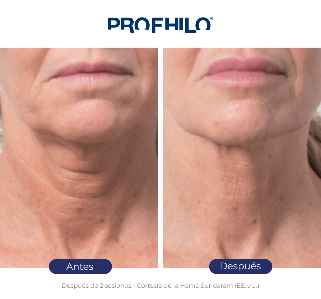 Profhilo Line - Bioestimuladores